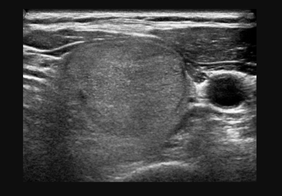 Thyroid Cyst Ultrasound Diagnosis Of Thyroid Nodules The Lancet