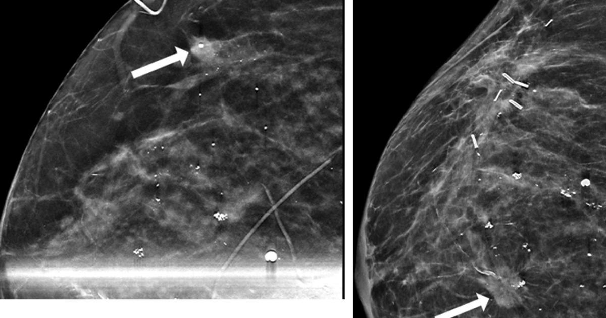 New data on DCIS surveillance imaging has experts concerned