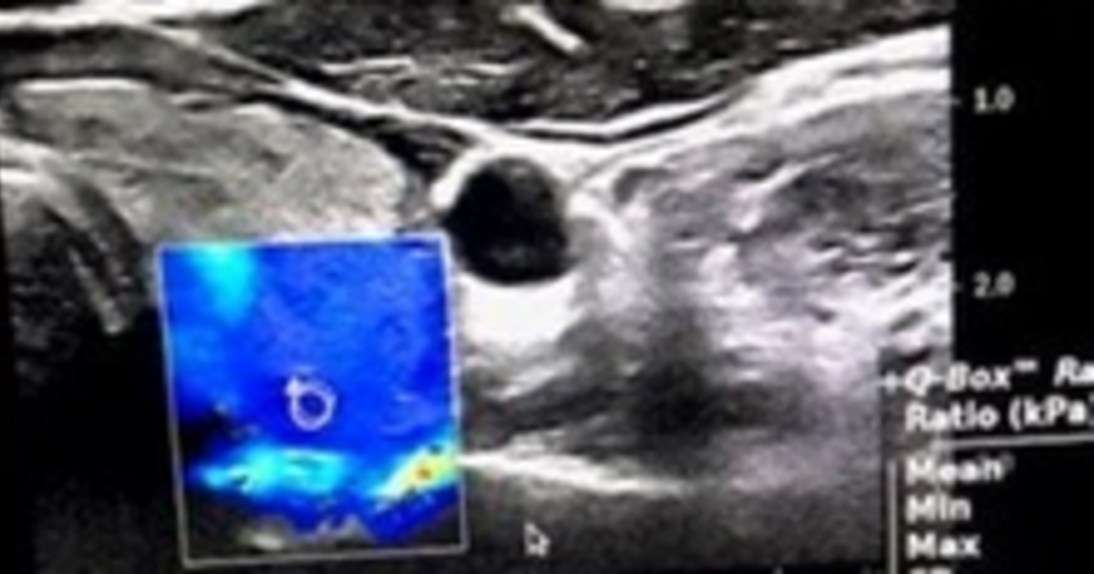 Shear wave elastography assessment improves TI-RADS scoring