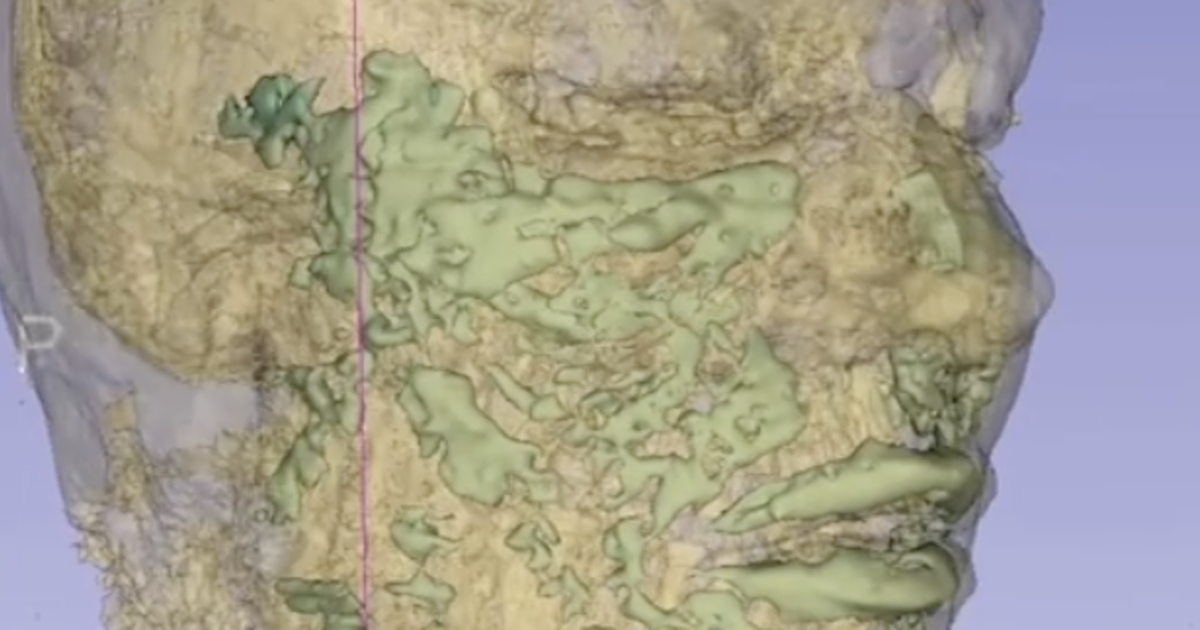 Imaging of woman with facial fillers prompts questions about whether ...