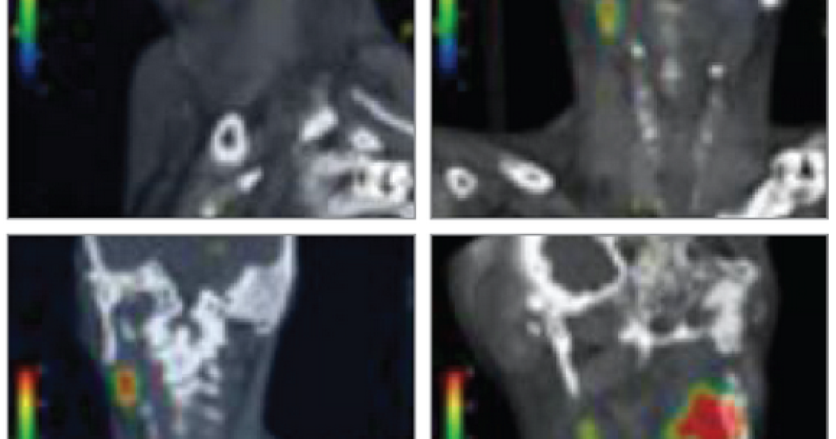 Lymphoseek: Newly approved for oral cavity cancer, more expansion expected