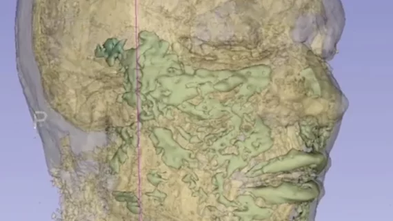 Imaging of woman with facial fillers prompts questions about whether ...